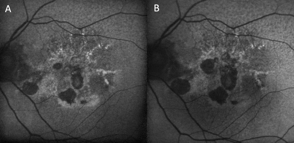Fundus Autofluorescence - EyeWiki