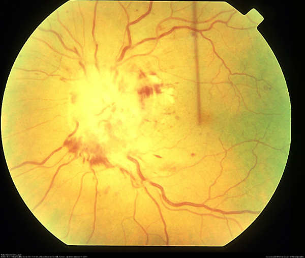 Waldenstrom Macroglobulinemia and Hyperviscosity-related Retinopathy ...