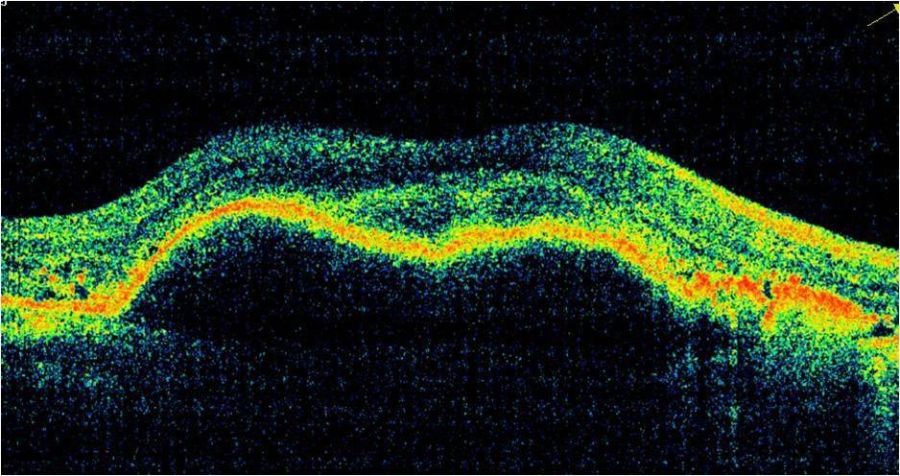 Optical Coherence Tomography - EyeWiki