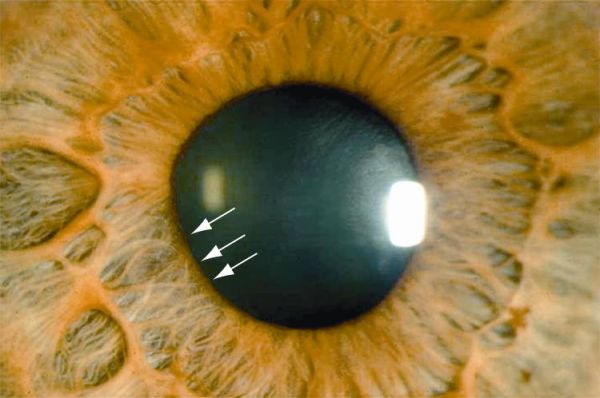 Adie Pupil - EyeWiki