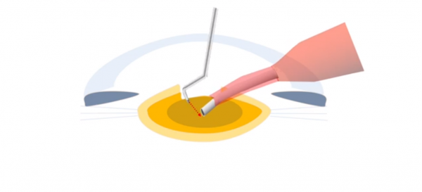 Vertical Chop Technique - EyeWiki