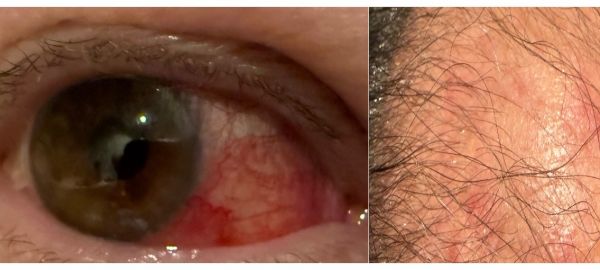Sweet Syndrome (Acute Febrile Neutrophilic Dermatosis) - EyeWiki