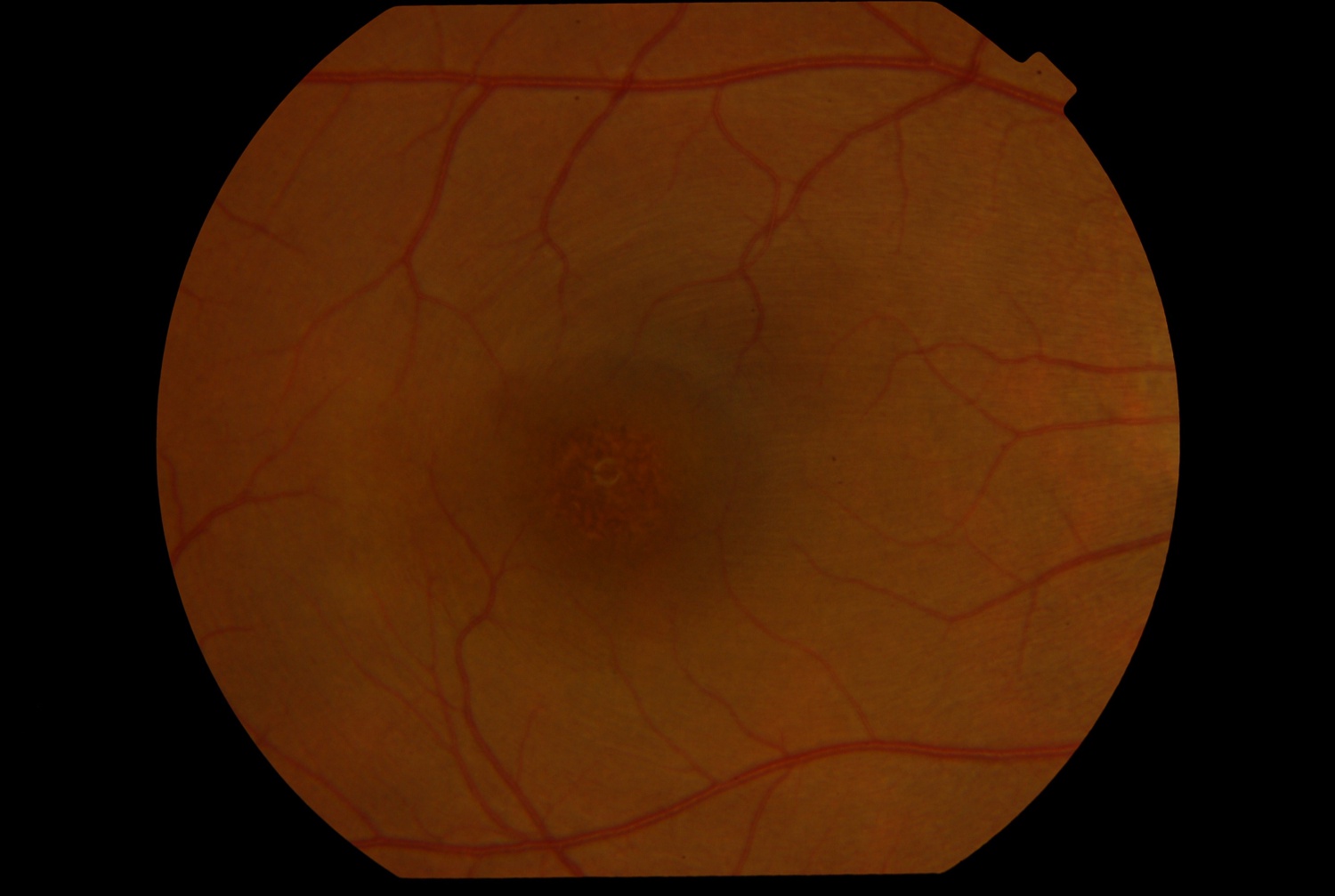 Acute Retinal Pigment Epitheliitis (Krill Disease) - EyeWiki