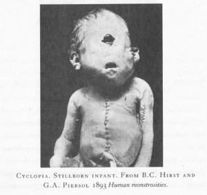 human cyclops condition