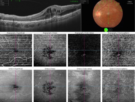 Choroidal Neovascularization: OCT Angiography Findings - EyeWiki