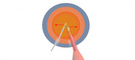 Vertical Chop Technique - EyeWiki