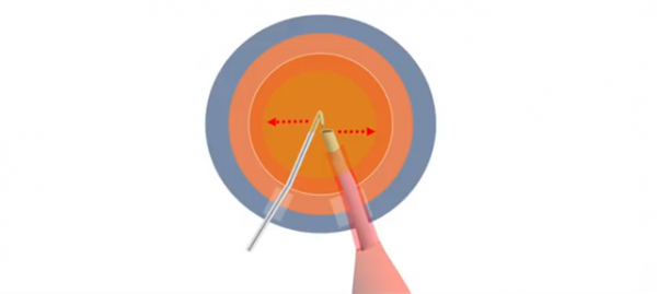 Vertical Chop Technique - EyeWiki