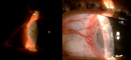 Corneal Dellen - EyeWiki