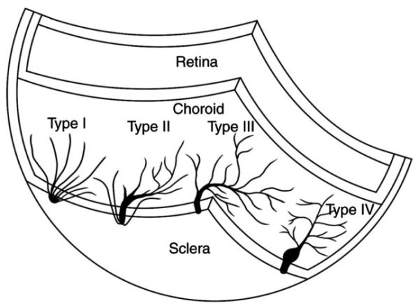 Vortex Vein Varix - EyeWiki