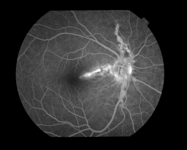 Angioid Streaks - EyeWiki