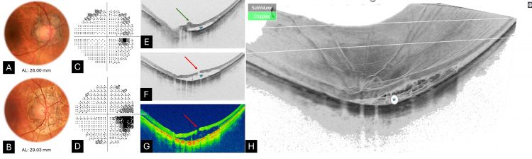 Pathologic Myopia (Myopic Degeneration) - EyeWiki