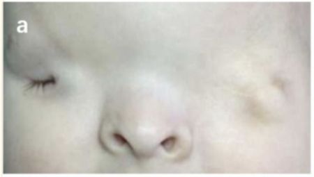 Cryptophthalmos - EyeWiki