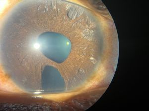 Iridocorneal Endothelial Syndrome and Secondary Glaucoma - EyeWiki