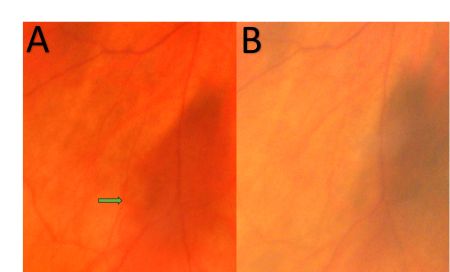 Choroidal Vascular Anomalies: Posterior Vortex Veins, Choroidal ...