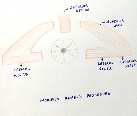Monocular Elevation Deficit - EyeWiki