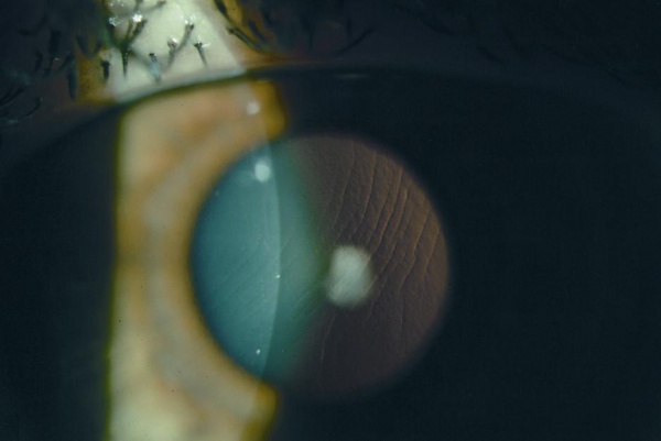 Flap Striae After LASIK - EyeWiki