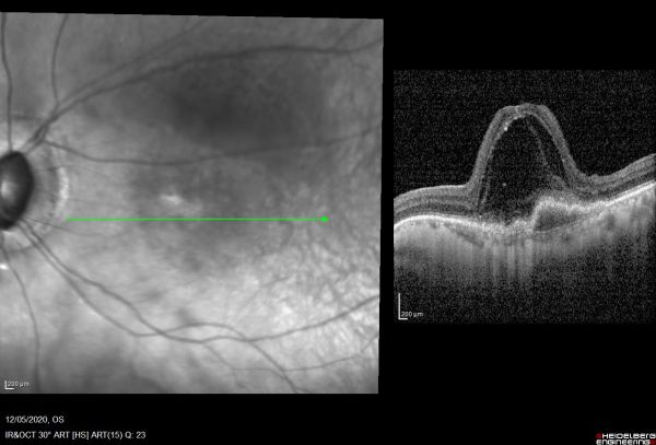 Bacillary Layer Detachment in Retina - EyeWiki