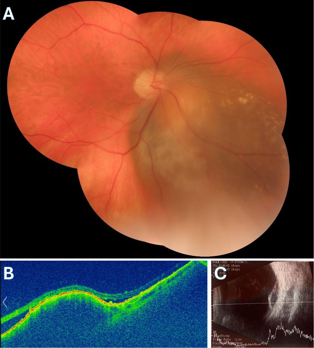 Choroidal and Ciliary Body Melanoma - EyeWiki
