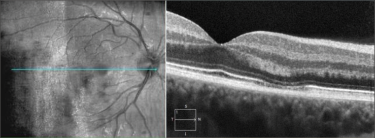 Acute Macular Neuroretinopathy - EyeWiki