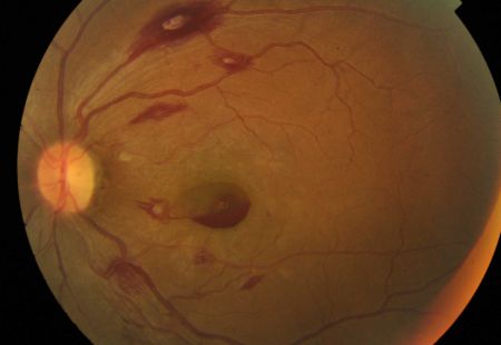 Retinal Manifestations of Leukemia - Leukemic Retinopathy - EyeWiki