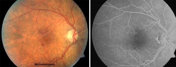 Ocular Ischemic Syndrome - EyeWiki