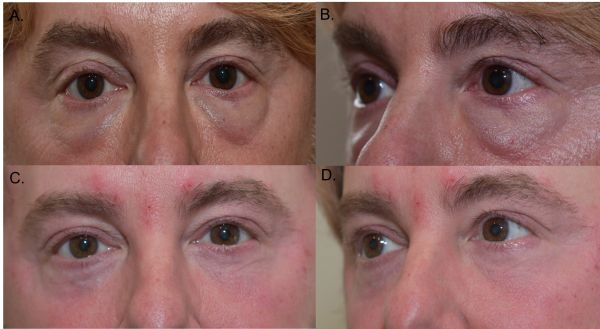 Tear Trough Deformity - EyeWiki