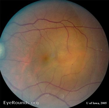 Retinal Detachment - EyeWiki