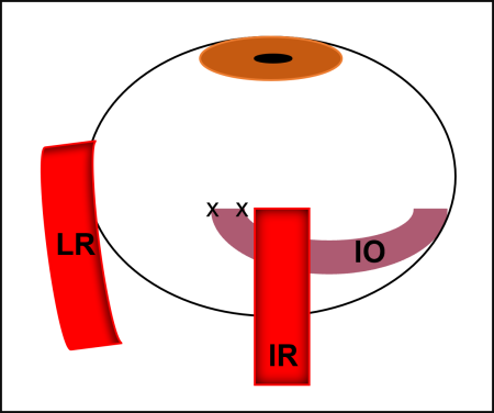 Strabismus Surgery, Cyclovertical - EyeWiki