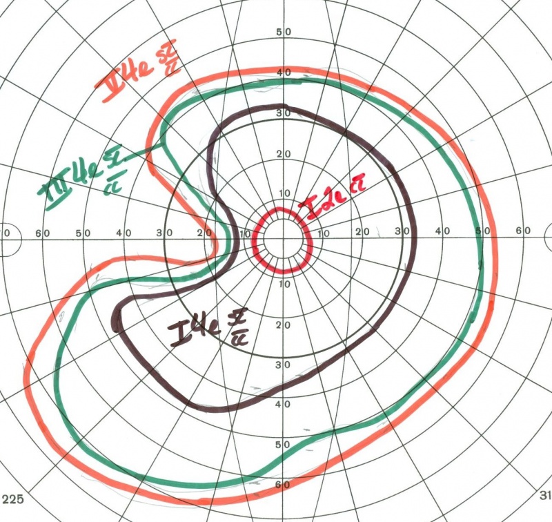 Tilted Disc Syndrome - EyeWiki