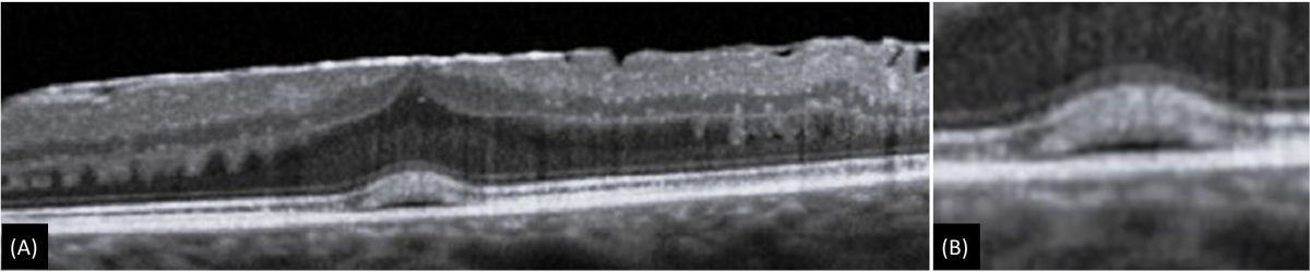 Central Foveal Bouquet Abnormalities - EyeWiki