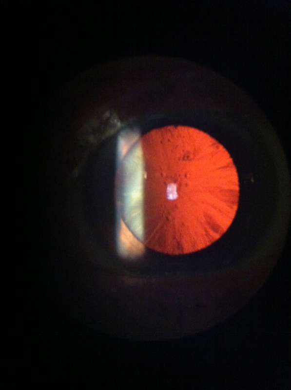 Cataract - EyeWiki