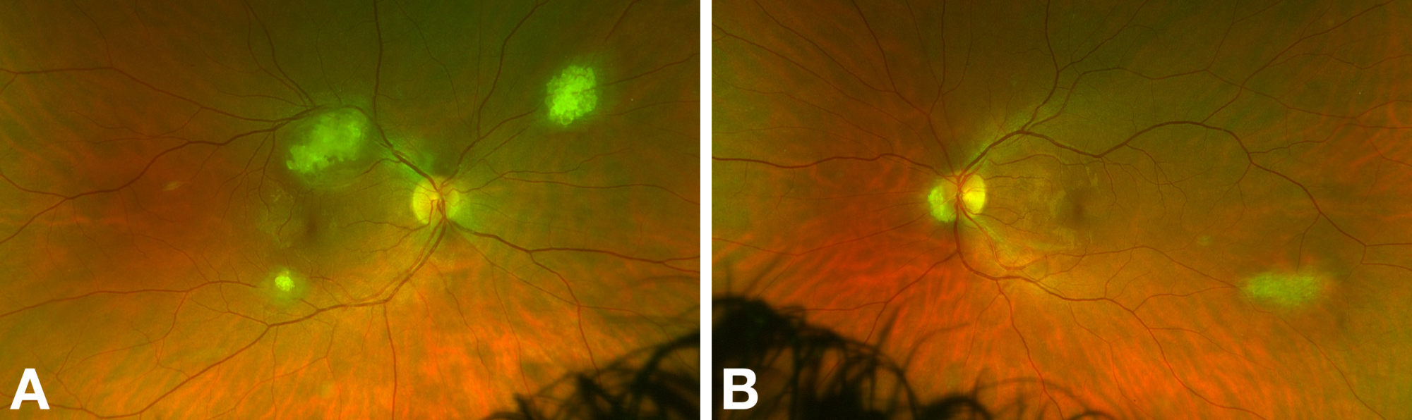 Retinal Astrocytic Hamartoma - EyeWiki