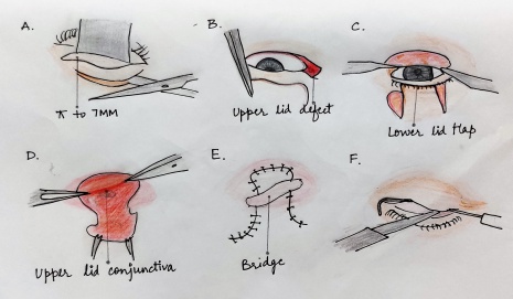 Eyelid Reconstruction - EyeWiki