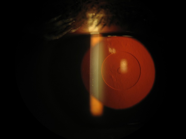 Corneal Inlays - EyeWiki