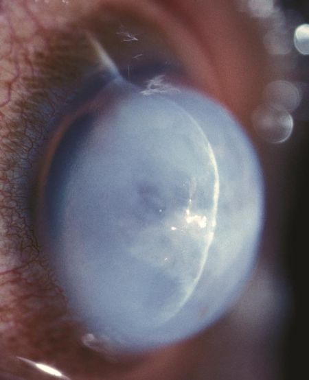Acute Corneal Hydrops - EyeWiki