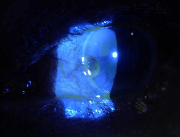 Corneal Dellen - EyeWiki