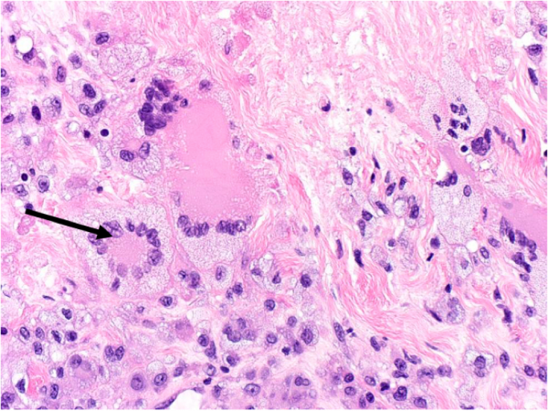 Necrobiotic Xanthogranuloma - EyeWiki