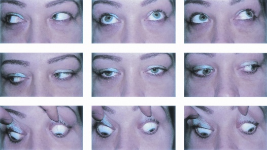Pattern Strabismus - EyeWiki