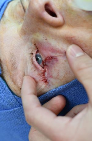Eyelid Reconstruction - EyeWiki