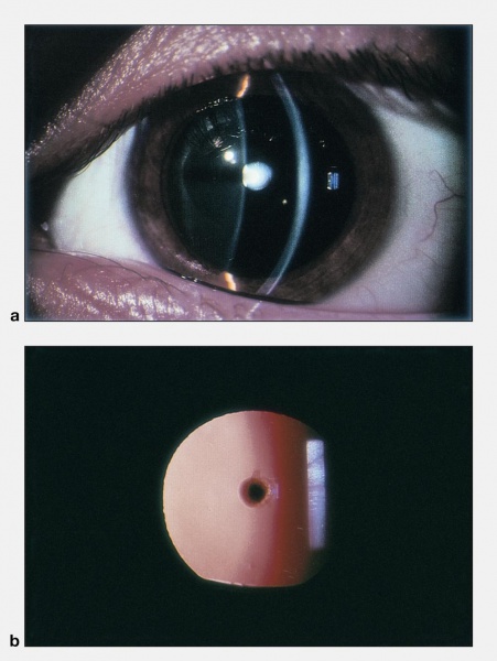 Cataract - EyeWiki