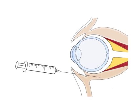 Anesthesia in Vitreoretinal Surgery - EyeWiki