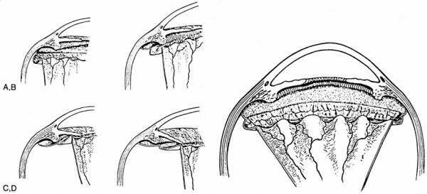 Proliferative Vitreoretinopathy - EyeWiki