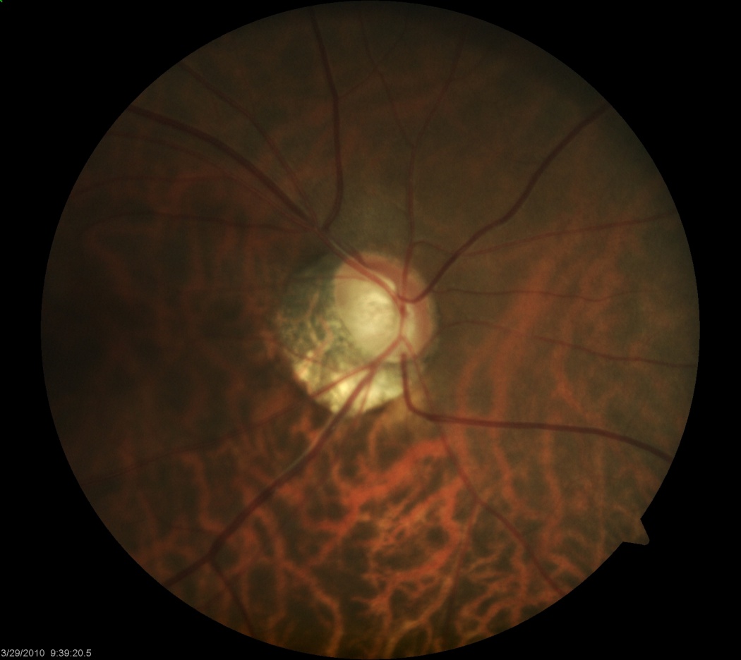 Examination of the Optic Nerve at the Slit-Lamp Biomicroscope with a ...