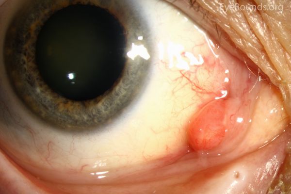 Pyogenic Granuloma - EyeWiki