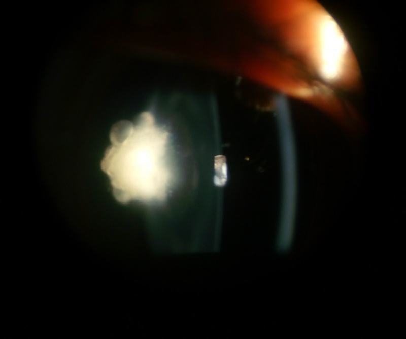 Cataract - EyeWiki