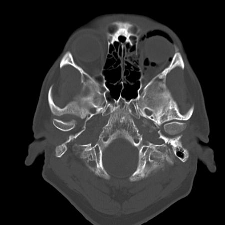 Orbital Emphysema - EyeWiki