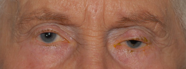 Trabeculectomy - EyeWiki