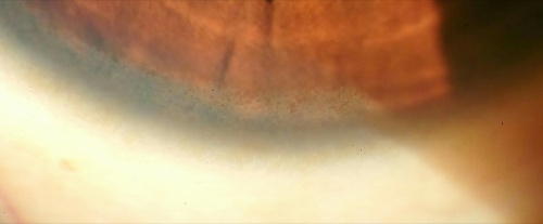 Wilson's Disease/Kayser Fleischer Ring - EyeWiki