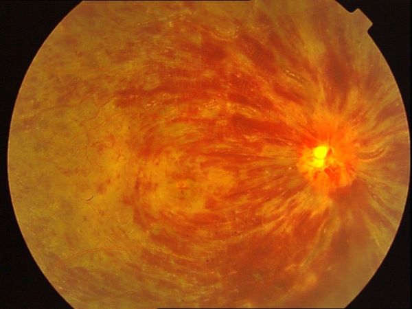 Retinal Manifestations of Leukemia - Leukemic Retinopathy - EyeWiki