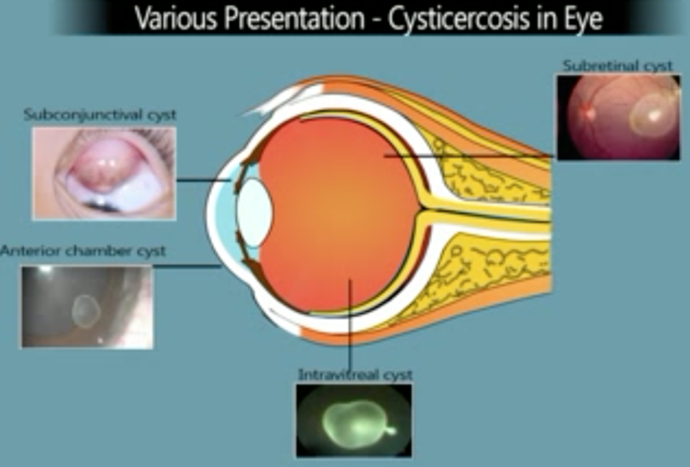 Cysticercosis of the Eye - EyeWiki